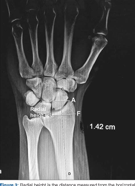 Figure From Morphometry Of Distal End Radius In The Indian Population A Radiological Study