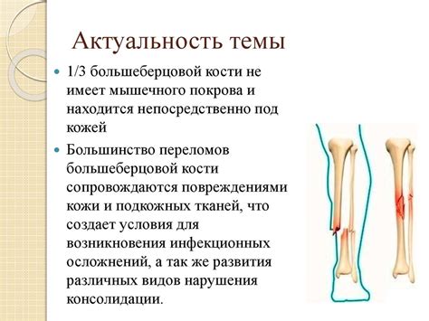 Хирургическое лечение переломов костей голени - презентация онлайн