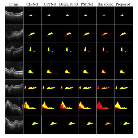 Examples Of CNV Segmentation From Left To Right Are Original Image Download Scientific