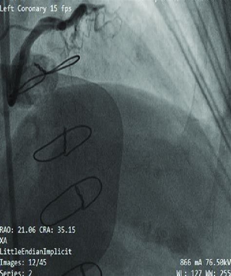 After Deployment Of The Stents Over The Left Circumflex Artery LCX A Download Scientific