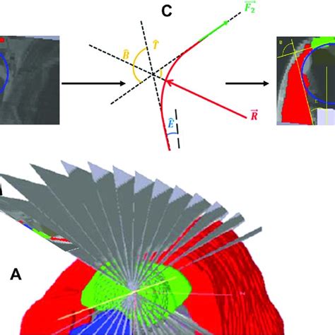 Classification Of Acromial Fractures From Levy Et Al Type I Small