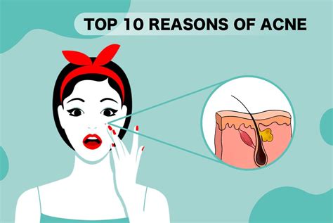 Causes For Acne Top 10 Reasons And How You Can Prevent Medinaz