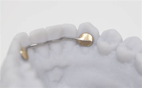 Lingual Retainer Rdl Russellville Dental Lab