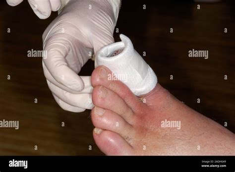 Dressing A Gangrenous Toe Nurse Dressing The Toe Of A 60 Year Old Man