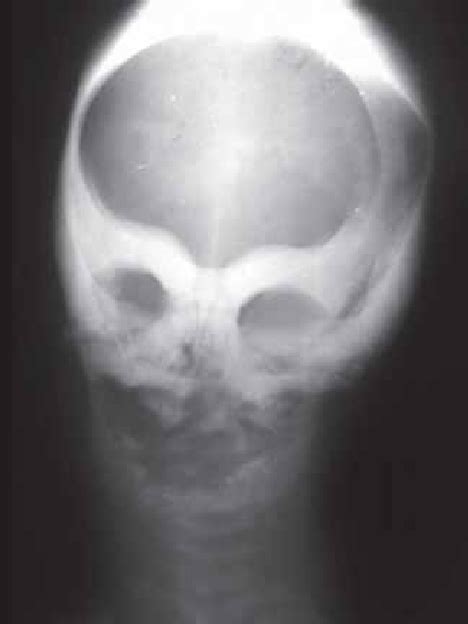 Posteroanterior View Showing Diffuse Sclerosis Of The Skull Download Scientific Diagram