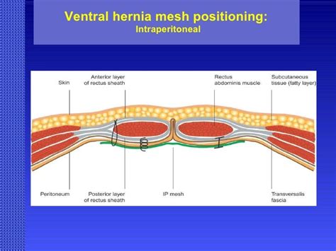 Hernia Mesh Tacks Medtronic Hernia Fixation Itvq