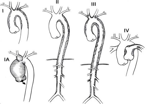 Diseases Of The Aorta Nonspecific Aortoarteritis Disease Abdominal