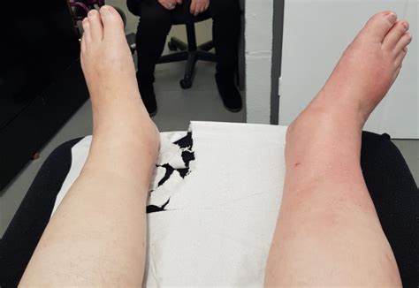 Multiple Sclerosis Edema Complications Having A Swell Time