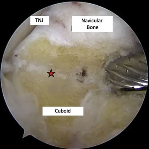 Arthroscopic View Of The Synchondrosis Before Resection The Surgeon Download Scientific