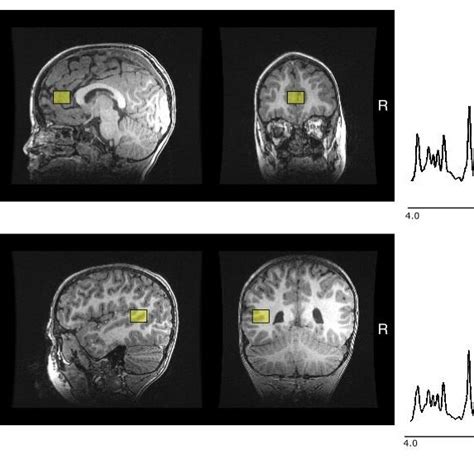 example voxel placement for the anterior cingulate cortex acc top