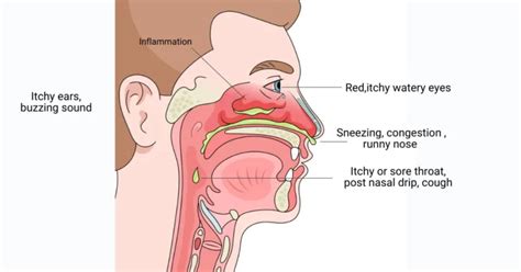 How To Treat Rhinitis And Ayurvedic Cure For Chronic Rhinitis