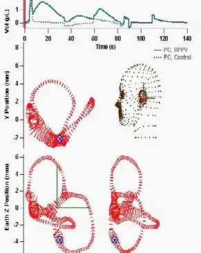 BPPV Best Practice Understanding Applying And Advancing The 2017 Revised OHNS BPPV Clinical