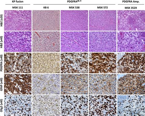 Histopathological Features Of Glioblastomas With The Pdgfra Mutant Download Scientific Diagram