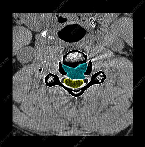 Enhanced Cervical Myelogram Ct Stock Image C027 1645 Science Photo Library