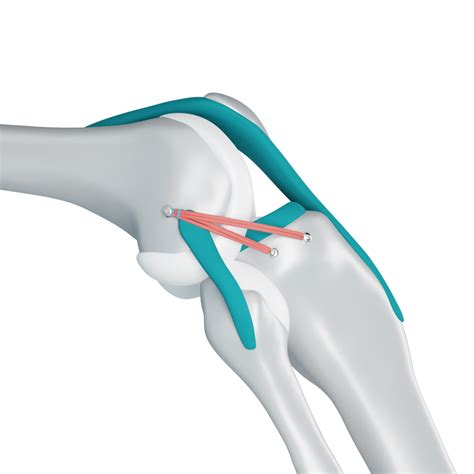 Ligamento Uterine Myoma Hospital De Loulé