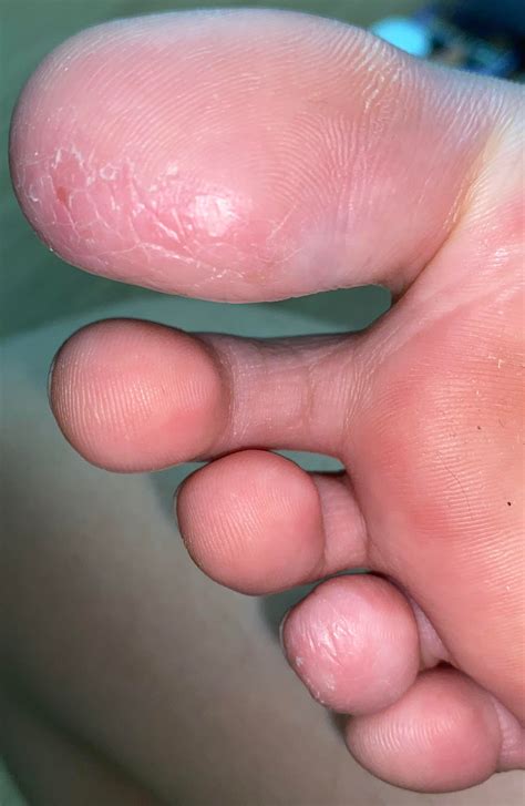 Dyshidrotic Eczema Both Feet Spreading Rdyshidrosis
