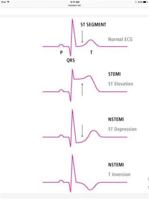 Nstemi Medical School Essentials Medical School Life Nursing School