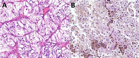 The Epithelioid Cells Revealed Clear Or Granular Eosinophilic Cytoplasm