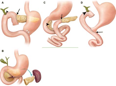 Imaging After Pancreatic Surgery Expected Findings And Postoperative