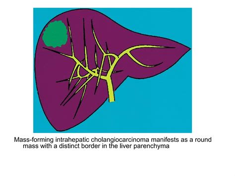 Diagnostic Imaging Of Cholangiocarcinoma Ppt