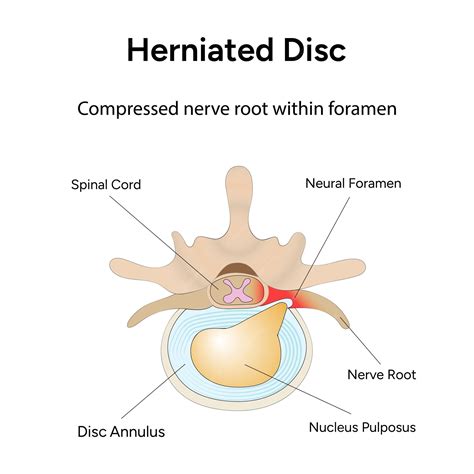 Premium Vector Herniated Disc Compressed Nerve Root Within Foramen In Vector