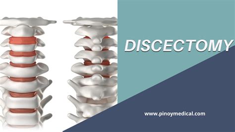Discectomy Price In The Philippines 2025 — Pinoymedical
