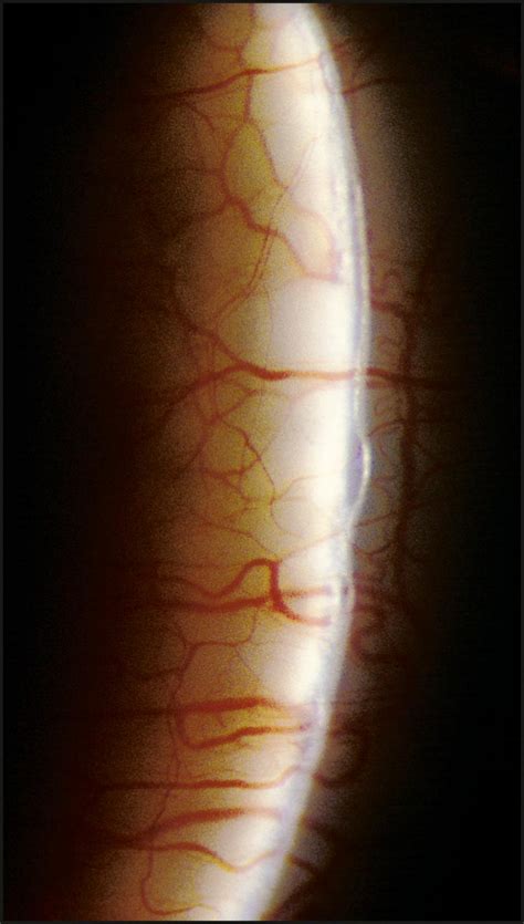 Slit Lamp Examination And Photography Clinical Tree