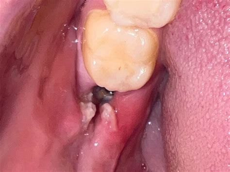 How To Prevent Dry Socket After Tooth Extraction