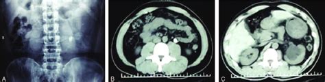 The Preoperative Imaging Modalities Of 1 Patient A Abdominal Plain
