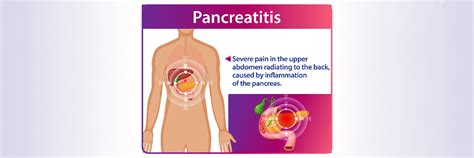 Pancreatitis Symptoms Nhs