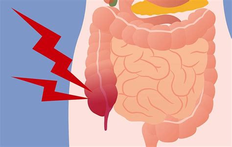 What Causes Your Appendix To Burst Emporiumsapje