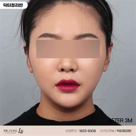 민트실리프팅 얼굴 팔자주름 민트실 리프팅 부작용 후붓기 후기 효과 닥터정리반 Youtube