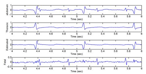 ECG adaptive linear neural network for fetal monitoring متلبی