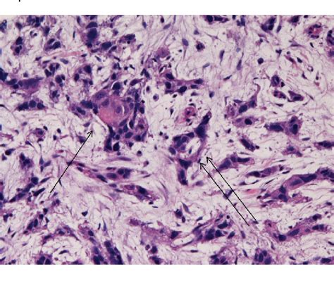 Figure 1 From Adenoid Squamous Cell Carcinoma Of The Oral Cavity