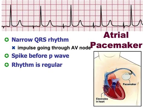 pacemaker rhythms