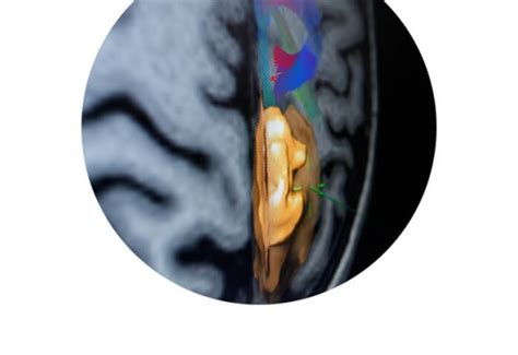 Brainlab Neuronavigation P Services