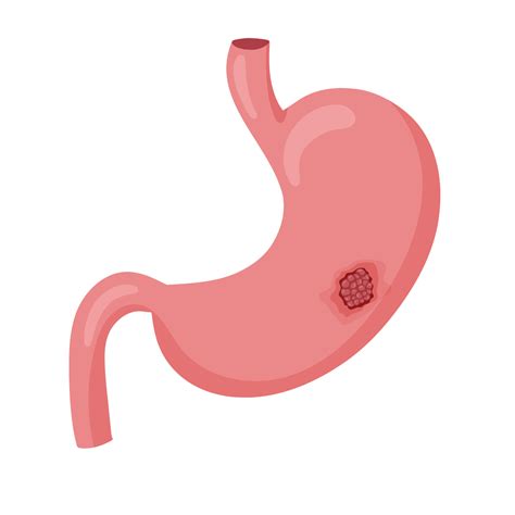 Stomach Cancer Malignant Cancerous Tumor Anatomical Vector