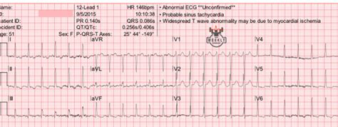 Differential Diagnoses The Main Three Things That Cause Narrow Complex Regular Tachycardias