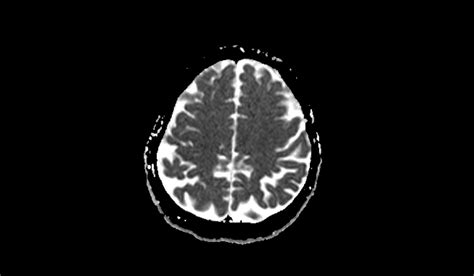 Multiple Sclerosisms Mri Radiology Article On Multiple Sclerosis