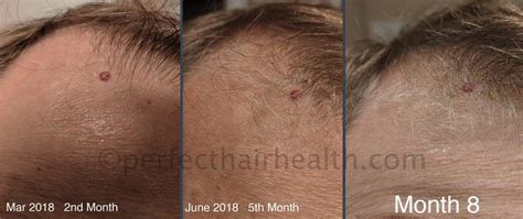 The Scalp Tension Theory Of Hair Loss A Scientific Breakdown