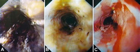 Acute Necrotizing Esophagitis Gastrointestinal Endoscopy