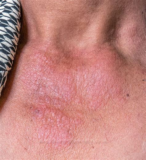 Polymorphic Light Eruption — Black And Brown Skin