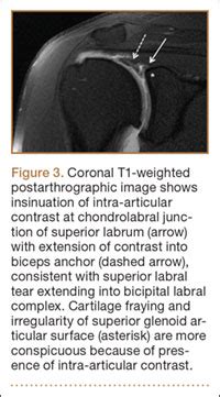 Imaging Evaluation Of Superior Labral Anteroposterior SLAP Tears MDedge Surgery
