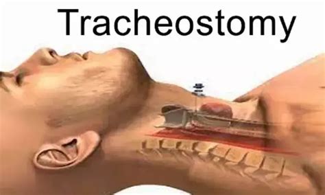 Tracheostomy Within Four Days Of Intubation Tied To Lower Short Term