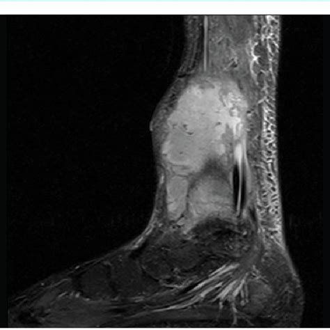 Mri Scan Of Left Tibia 5 0613 Intramedullary Lytic Lesion Of Lower
