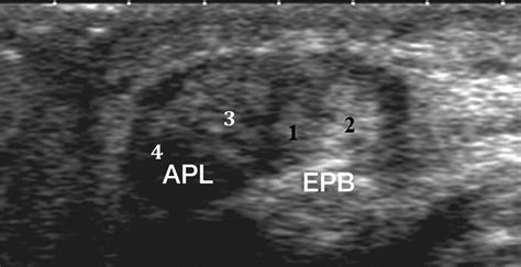 Extensor Compartment Radiology At Phoebe Bateman Blog
