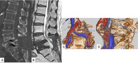 Images At The 9 Month Follow Up A Mid Sagittal Reconstruction Ct Download Scientific