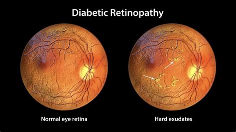 Diabetic Retinopathy Vision