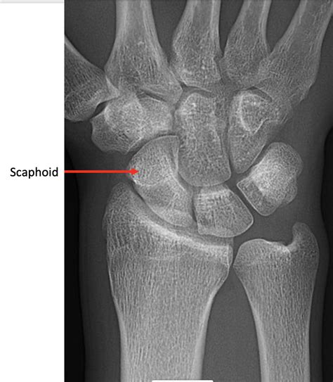 The ‘query Scaphoid Injury Lothian Virtual Hand Clinic