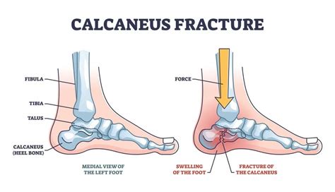 Calcaneus Bodybuildingde Das Portal Rund Ums Bodybuilding